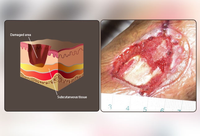 Breaking Down Bedsores and Understanding Ulcers: Pressure Injuries
