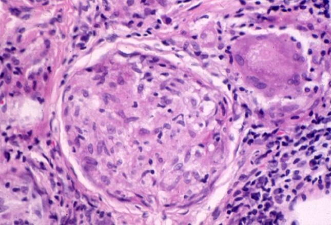 Cutaneous Signs of 10 Unusual Systemic Diseases