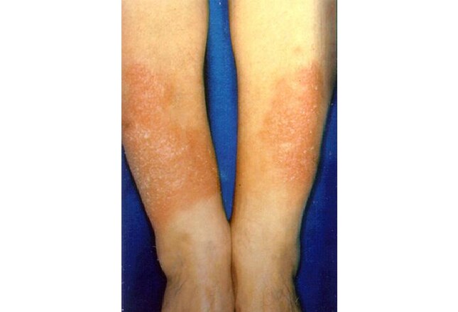 Cutaneous Signs of 10 Unusual Systemic Diseases