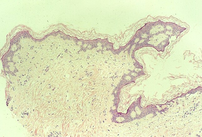 Cutaneous Signs of 10 Unusual Systemic Diseases