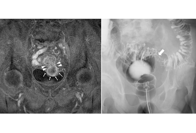 Colorectal Cancer: Prevention, Diagnosis, and Therapeutic Options