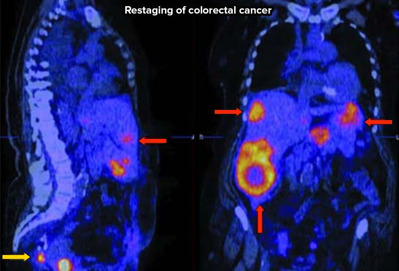 Colorectal Cancer: Prevention, Diagnosis, and Therapeutic Options