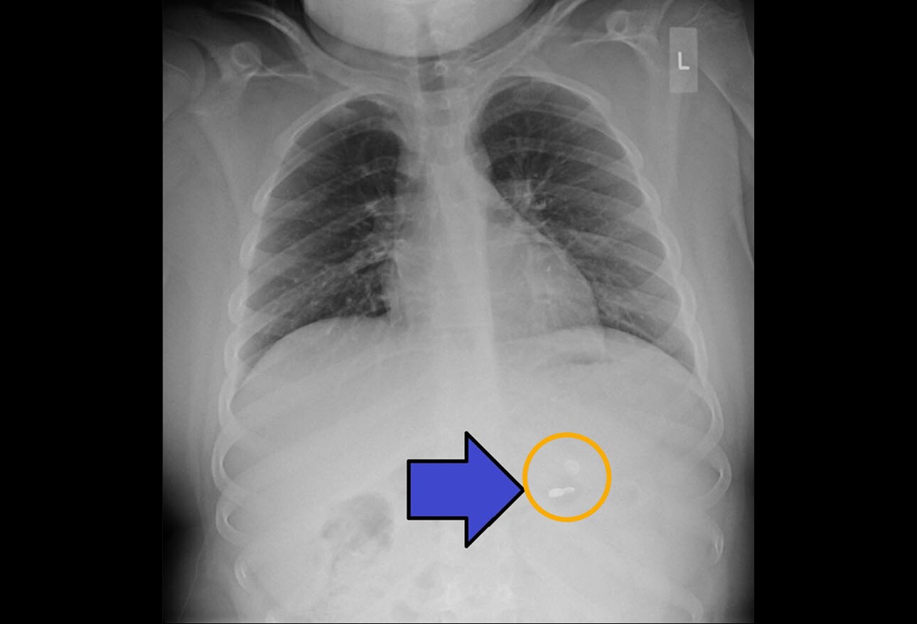 14 Common Pediatric Ingestions to Know