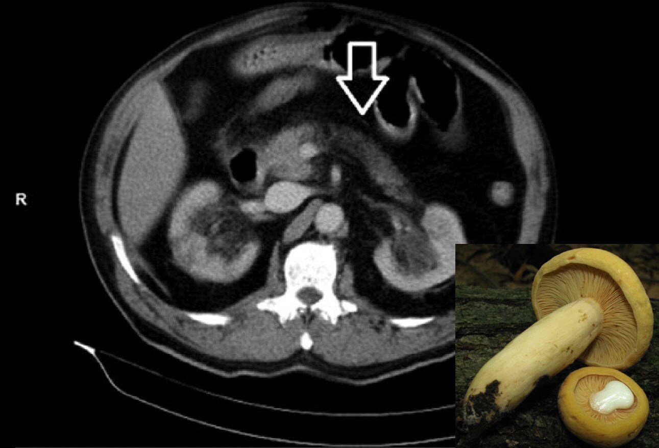 14 Common Pediatric Ingestions to Know