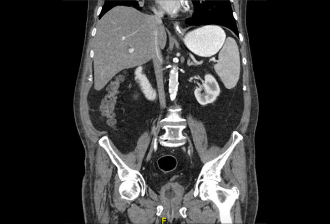 11 Community-Acquired Infections