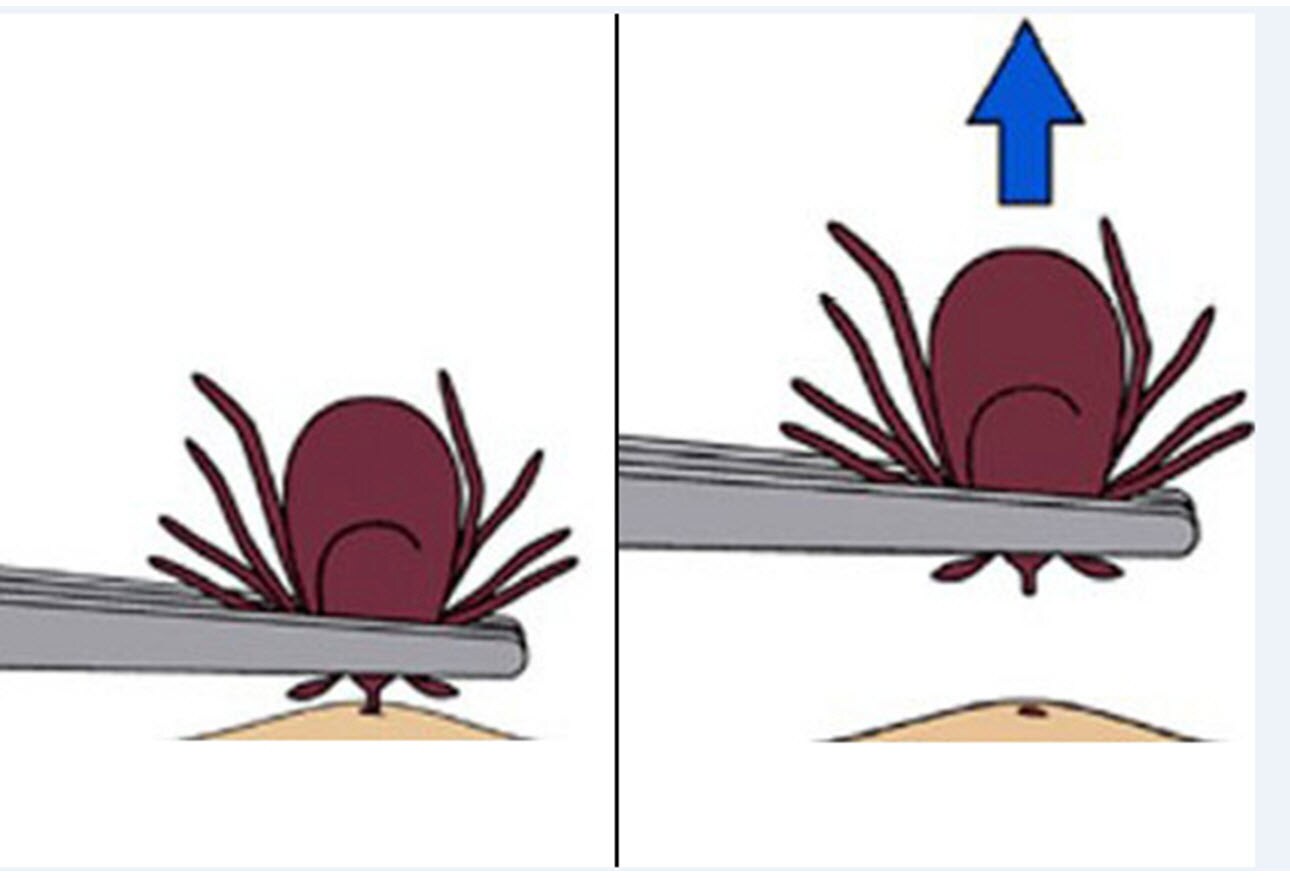 11 Community-Acquired Infections