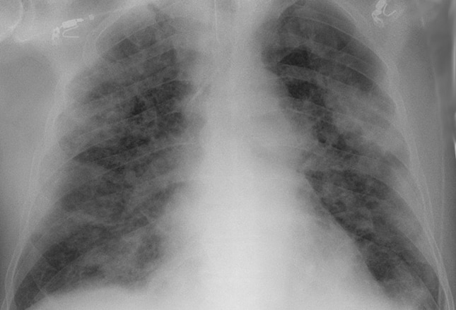 11 Community-Acquired Infections