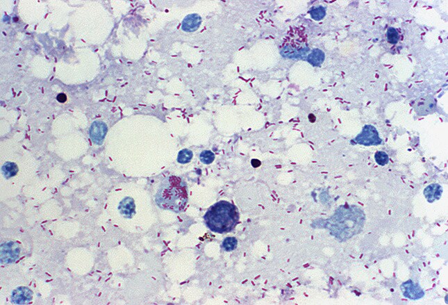 11 Community-Acquired Infections