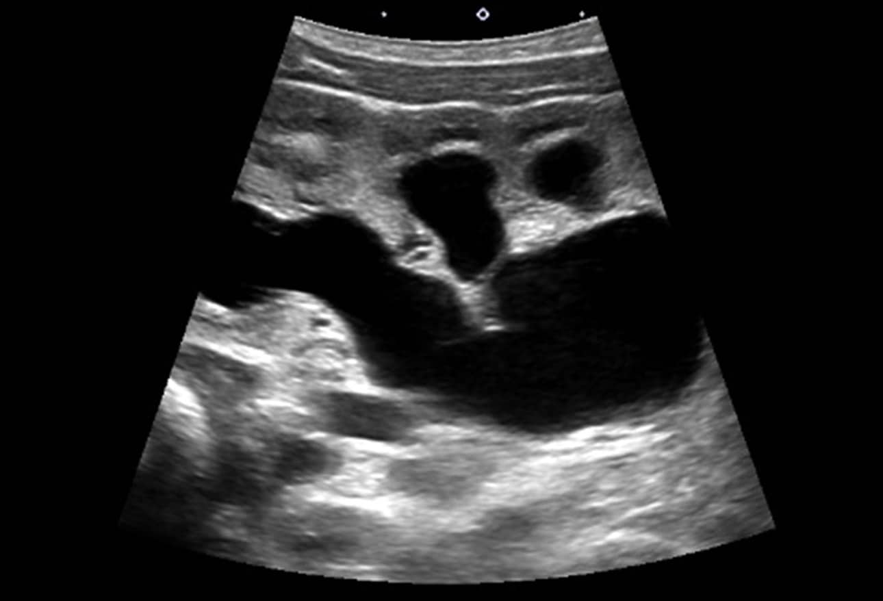 Congenital Anomalies of the Genitourinary System