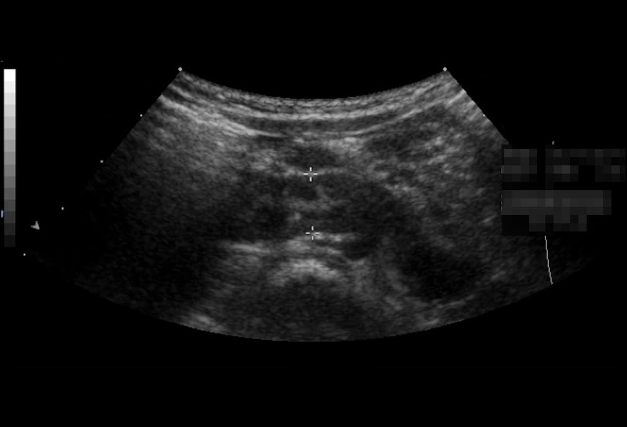 Congenital Anomalies of the Genitourinary System