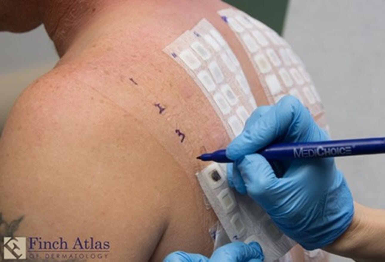 Contact Dermatitis: A Summary