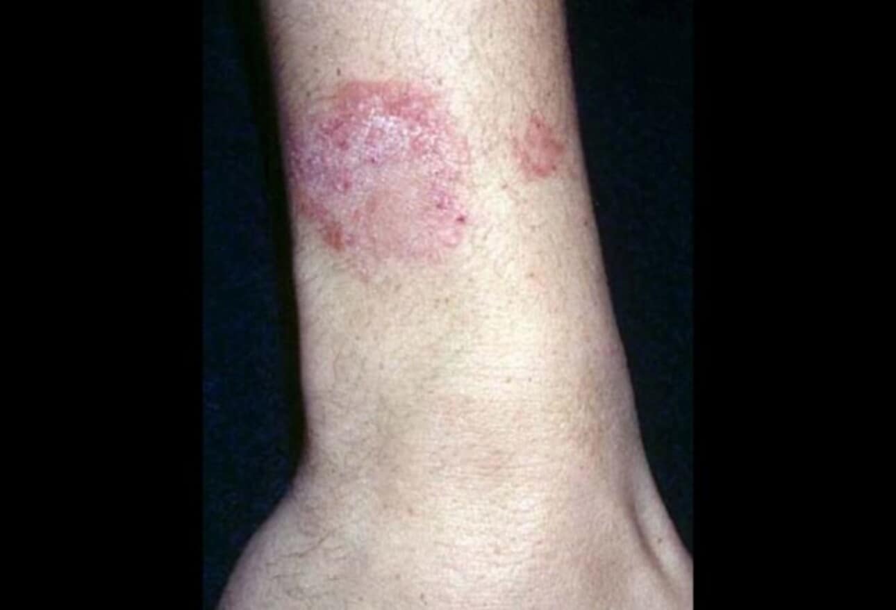 Contact Dermatitis: A Summary