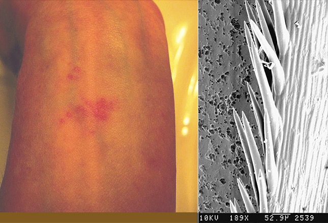 Contact Dermatitis: An Overview