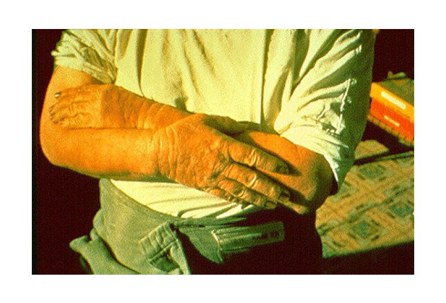 Contact Dermatitis: An Overview