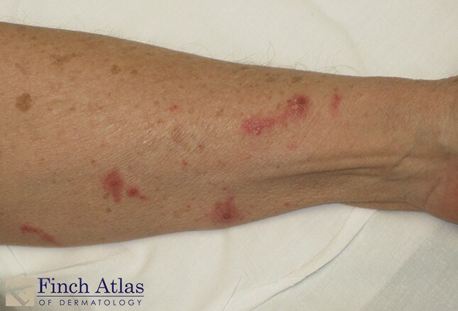 Contact Dermatitis: An Overview