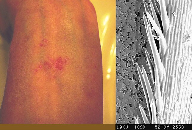 Contact Dermatitis: An Overview