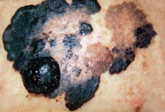 Deadly Skin Cancers You Need to Know