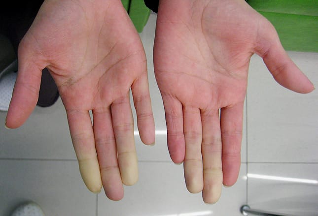 Diagnostic Error in the Patient With Rheumatologic Symptoms