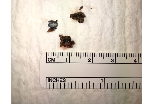 9 Causes of Discolored Urine