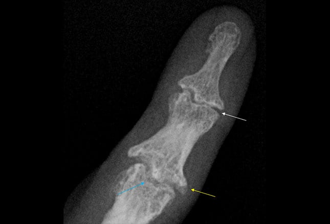 Can't-Miss Radiographic Changes in Rheumatologic Disease