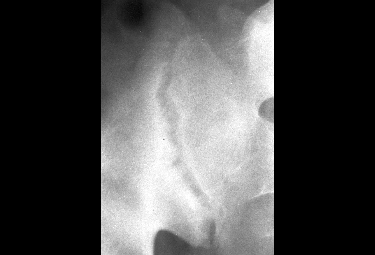 Can't-Miss Radiographic Changes in Rheumatologic Disease