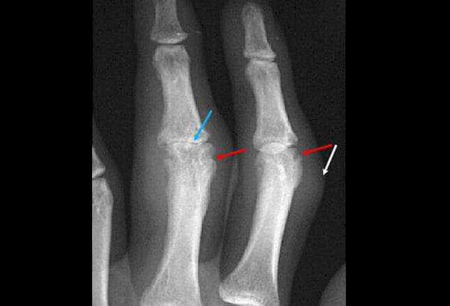 Can't-Miss Radiographic Changes in Rheumatologic Disease