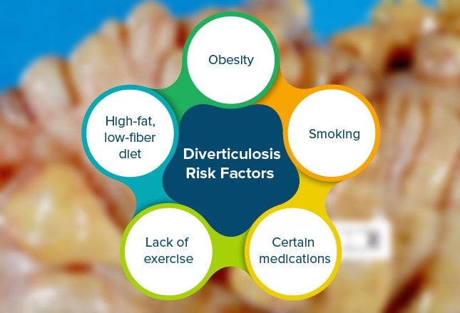 Diverticulitis: It’s (Sometimes) Complicated