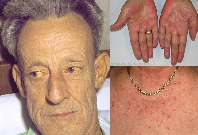 Physical Manifestations of 9 Drugs of Abuse