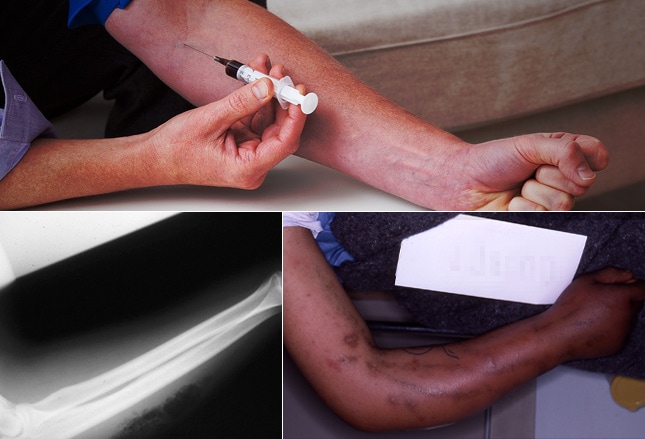 Physical Manifestations of 9 Drugs of Abuse