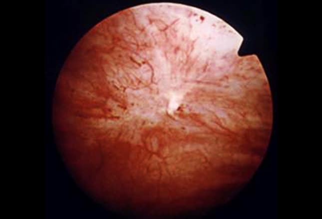 Dysuria: When It Hurts to Go With the Flow