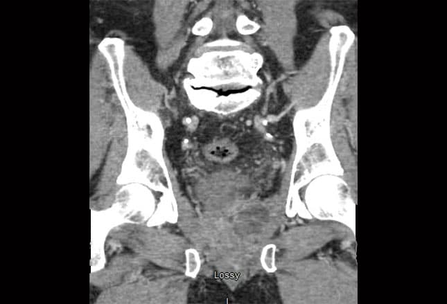 Dysuria: When It Hurts to Go With the Flow