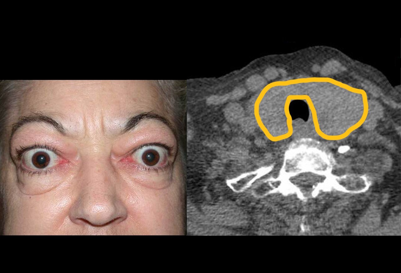 On Strike or Working Overtime: 13 Endocrine Emergencies