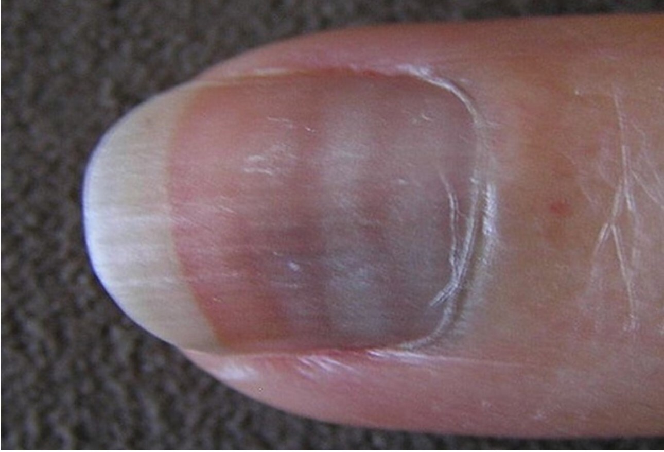 15 Fingernail and Toenail Abnormalities