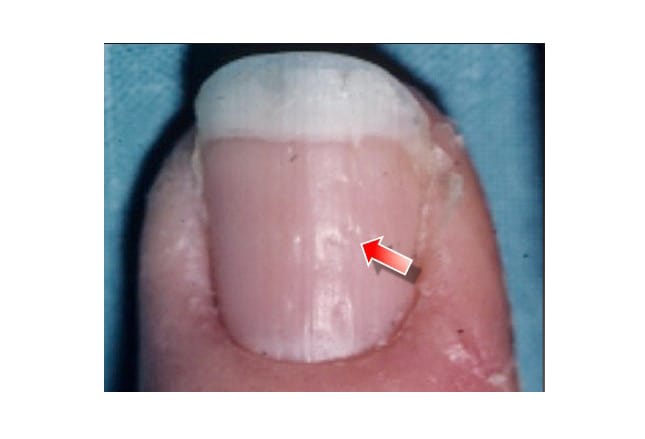 15 Fingernail and Toenail Abnormalities