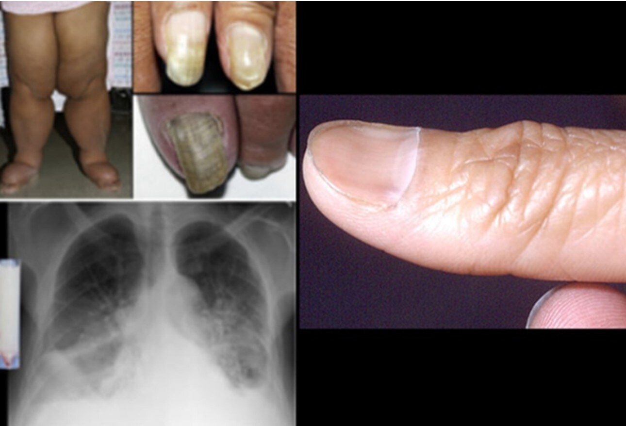 15 Fingernail and Toenail Abnormalities
