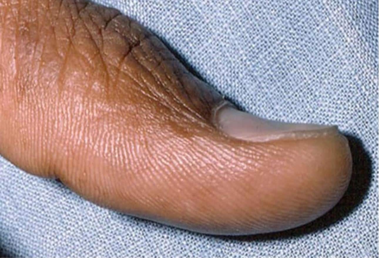 15 Fingernail and Toenail Abnormalities