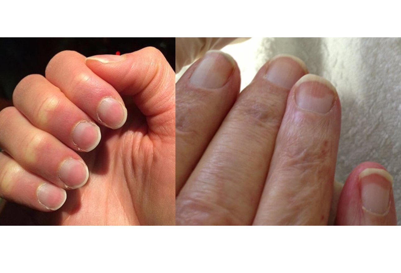 15 Fingernail and Toenail Abnormalities