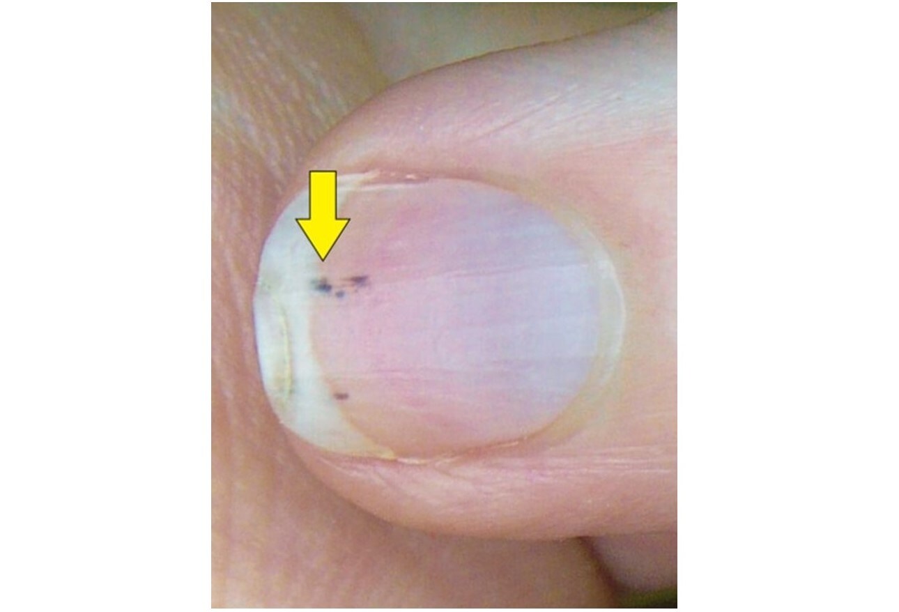 15 Fingernail and Toenail Abnormalities: Indicators of Patient Health