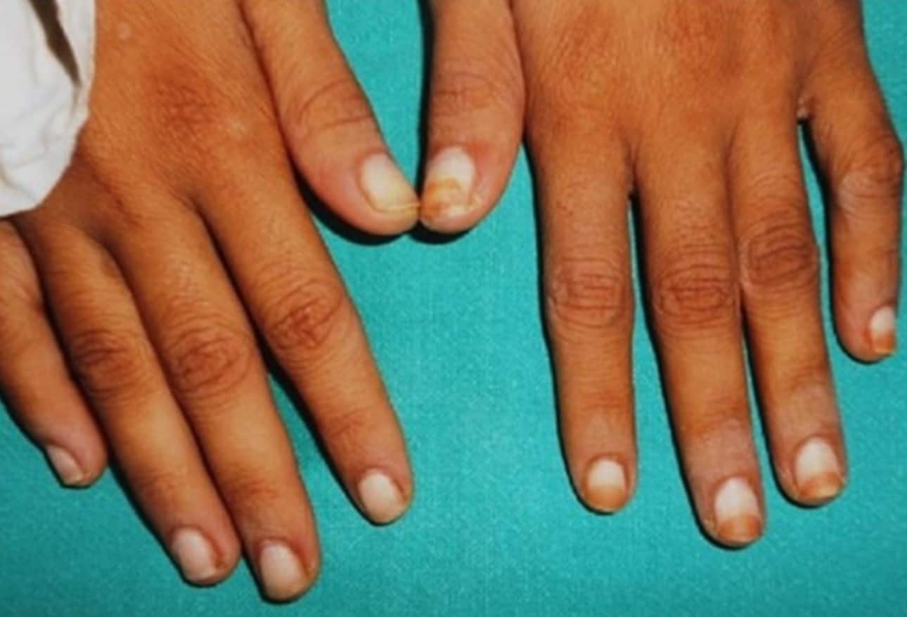 15 Fingernail and Toenail Abnormalities: Indicators of Patient Health