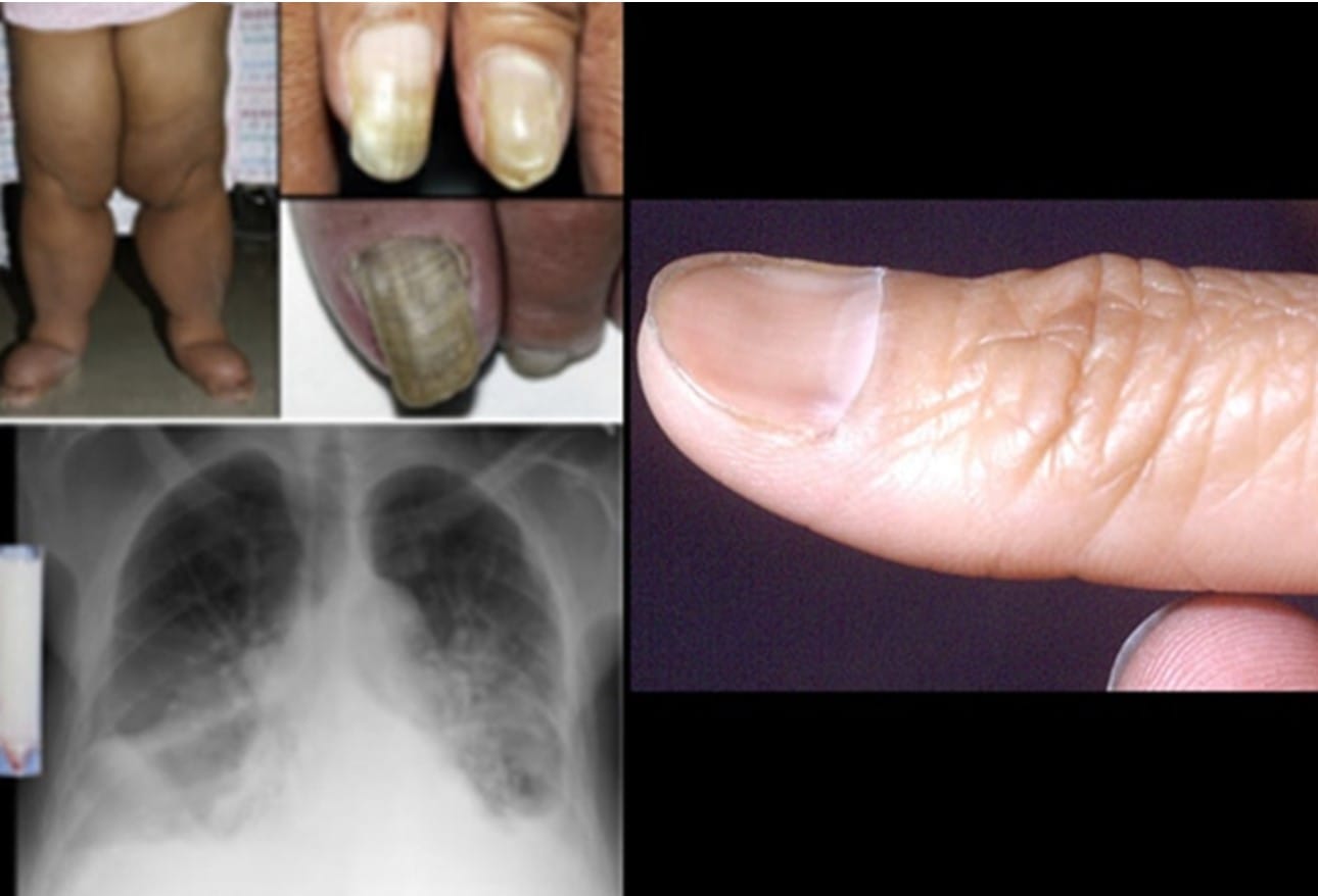 15 Fingernail and Toenail Abnormalities: Indicators of Patient Health