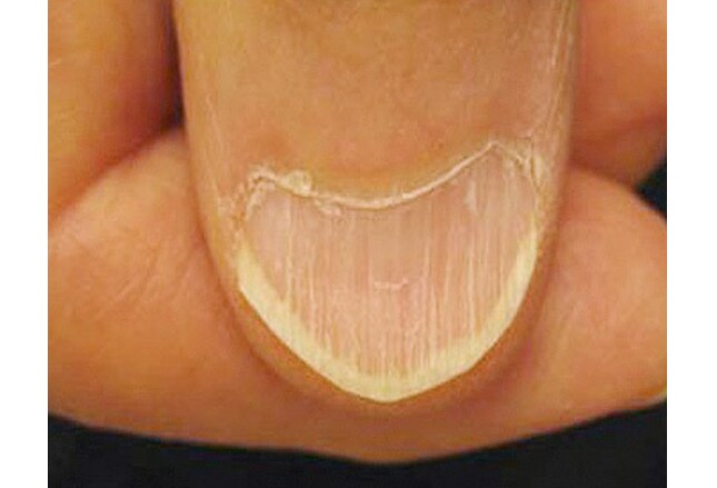 Fingernail and Toenail Abnormalities: Nail the Diagnosis