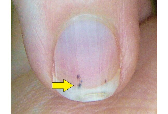 Fingernail and Toenail Abnormalities: Nail the Diagnosis