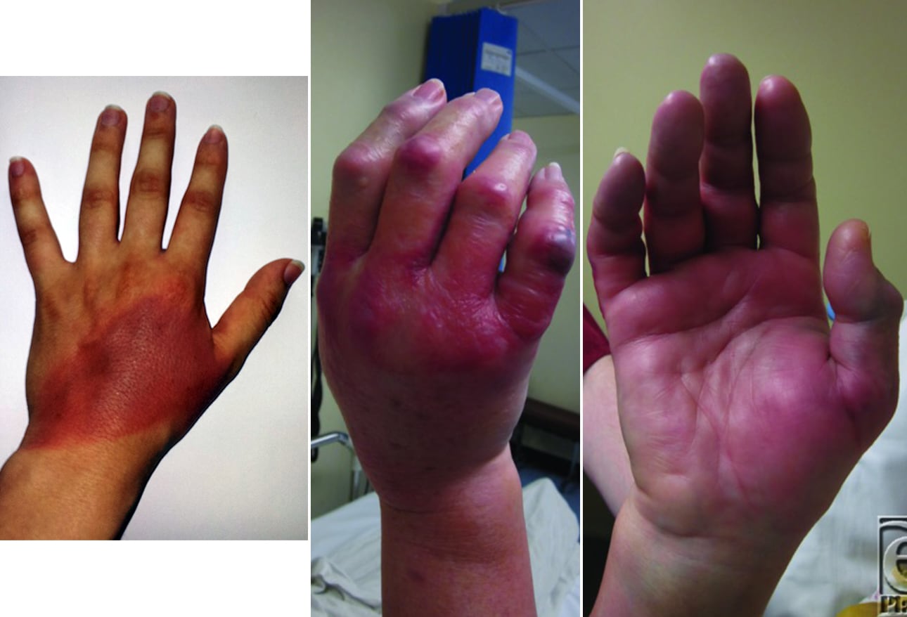 Fireworks Injuries: Ooh, Aah...Ouch!