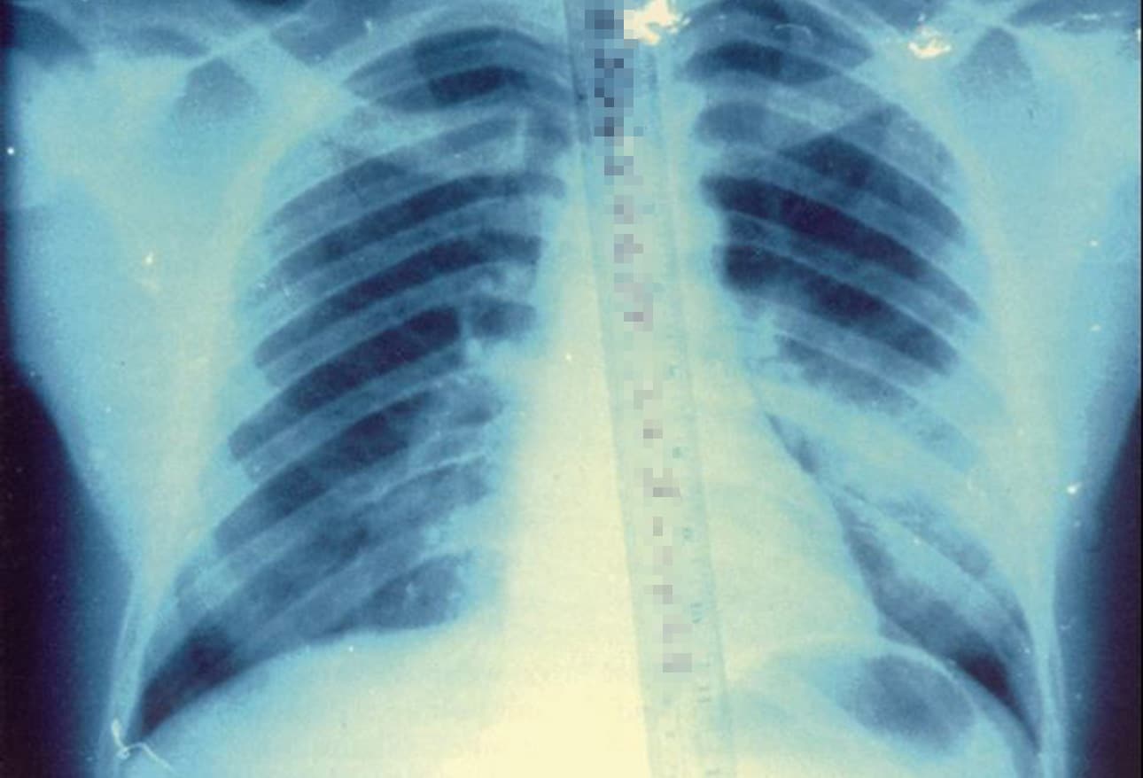 Fireworks Injuries: Ooh, Aah...Ouch!