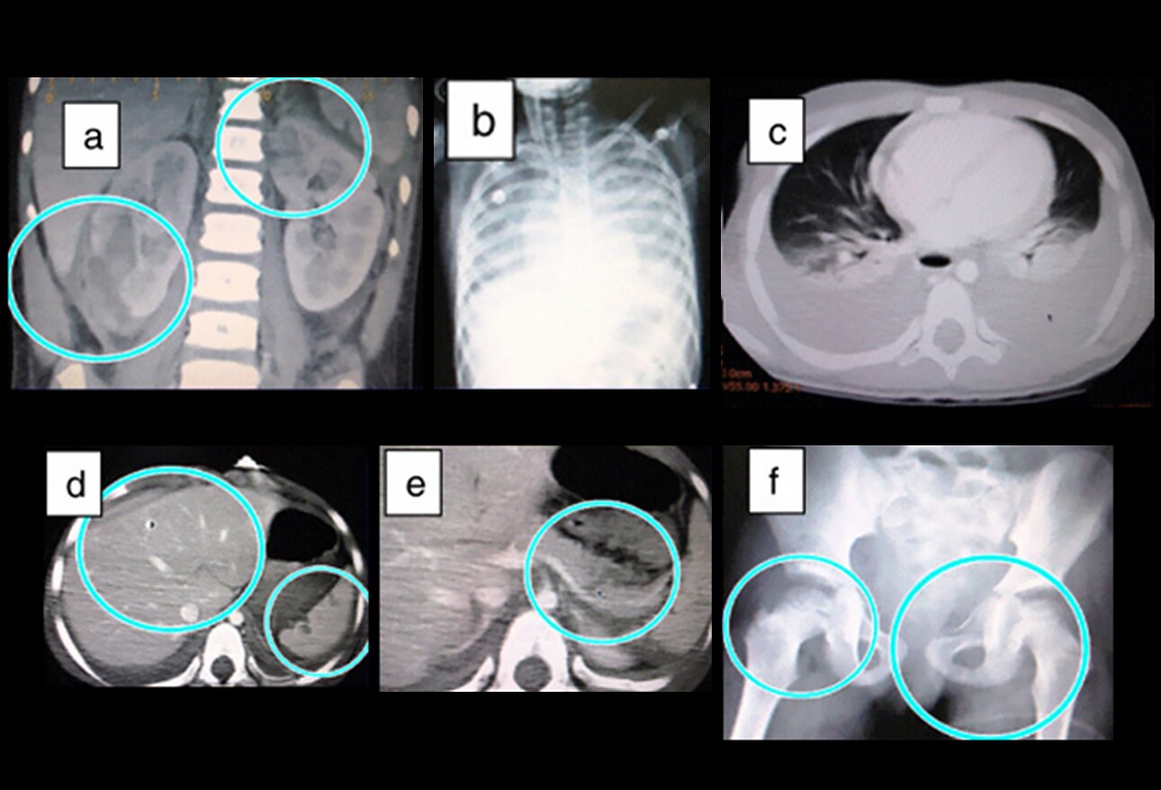 Fireworks Injuries: Ooh, Aah...Ouch!