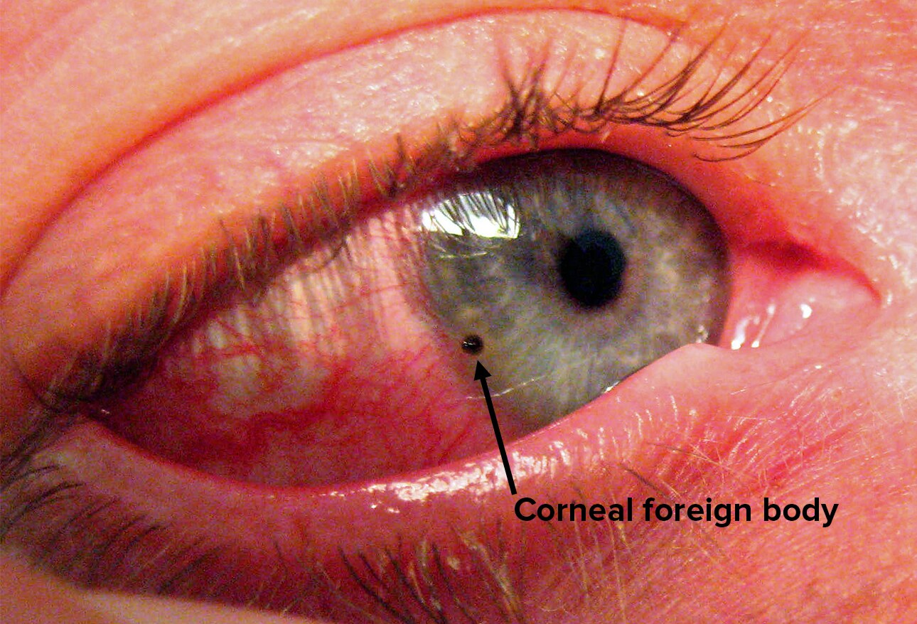 Fireworks Injuries: Ooh, Aah...Ouch!