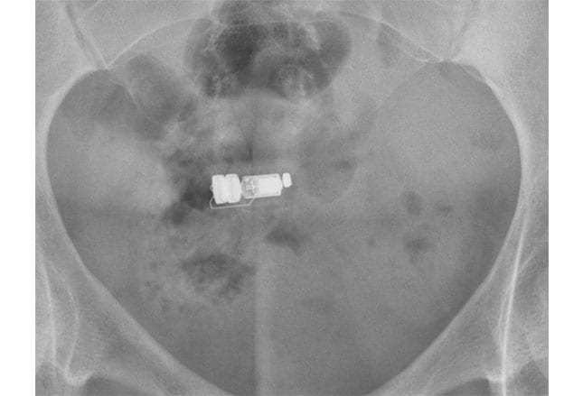 Foreign Bodies in the Gastrointestinal and Genitourinary Tracts ...