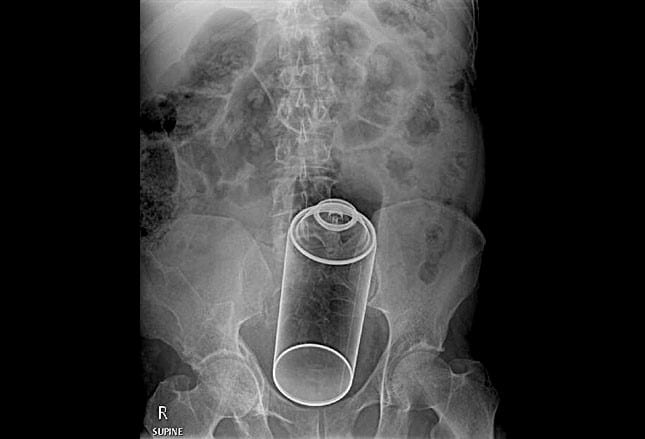 Foreign Bodies in the Gastrointestinal and Genitourinary Tracts ...