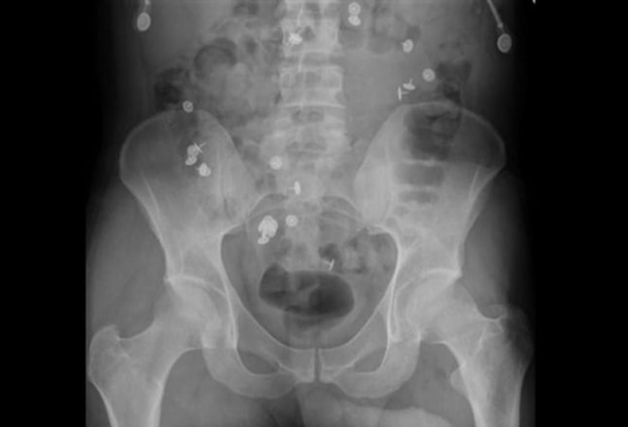 Foreign Bodies in the Gastrointestinal and Genitourinary Tracts ...