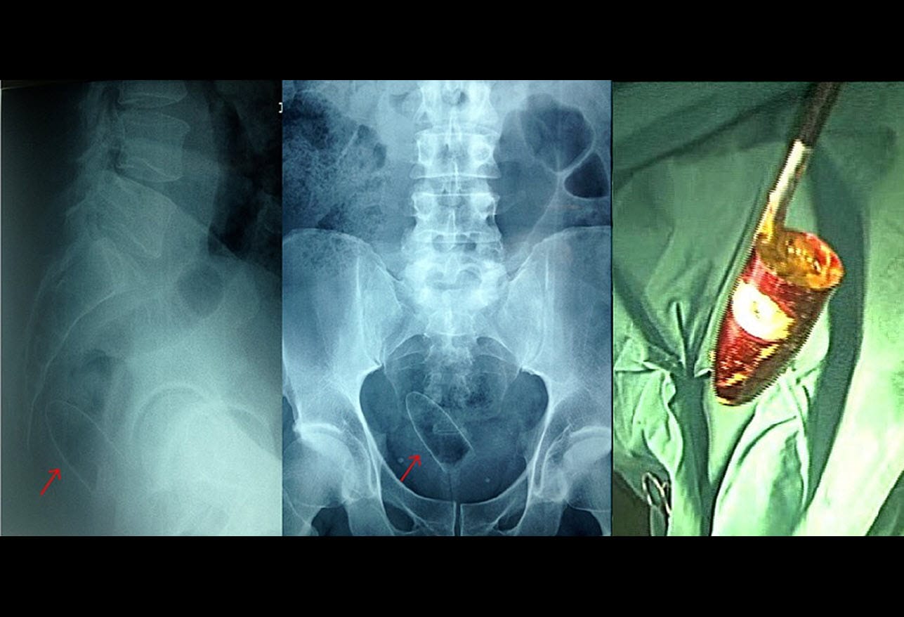 Foreign Bodies in the Gastrointestinal and Genitourinary Tracts ...
